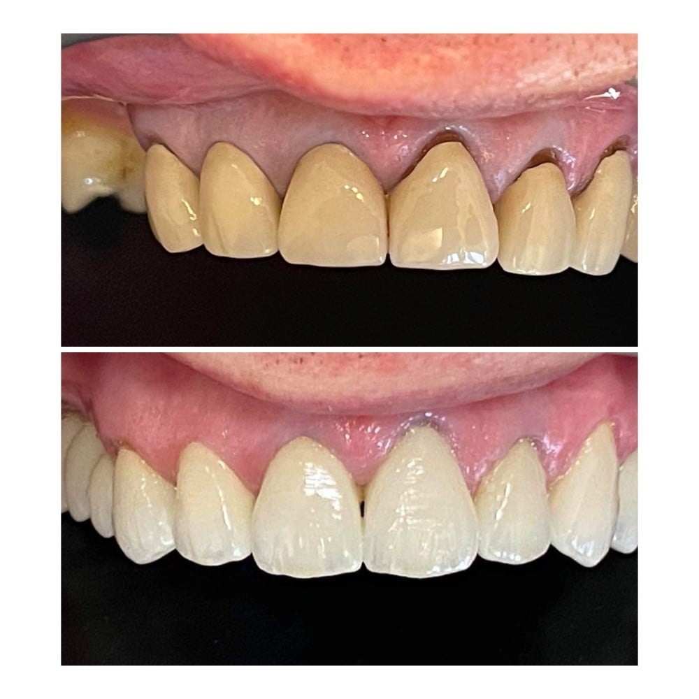 Dental Crowns - What are they and what are they made from?