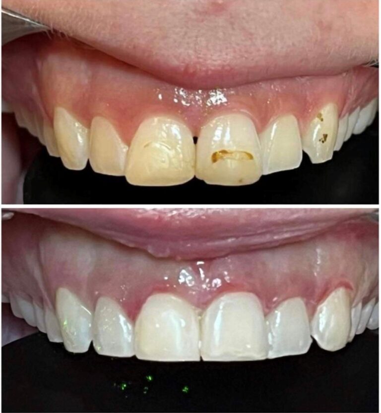 Composite Bonding: Does it Stain, and What Can Be Done? | Dentist Isle ...
