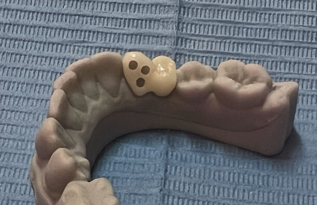 Dental Bridge - Bridgework Dental - Oral Bridge