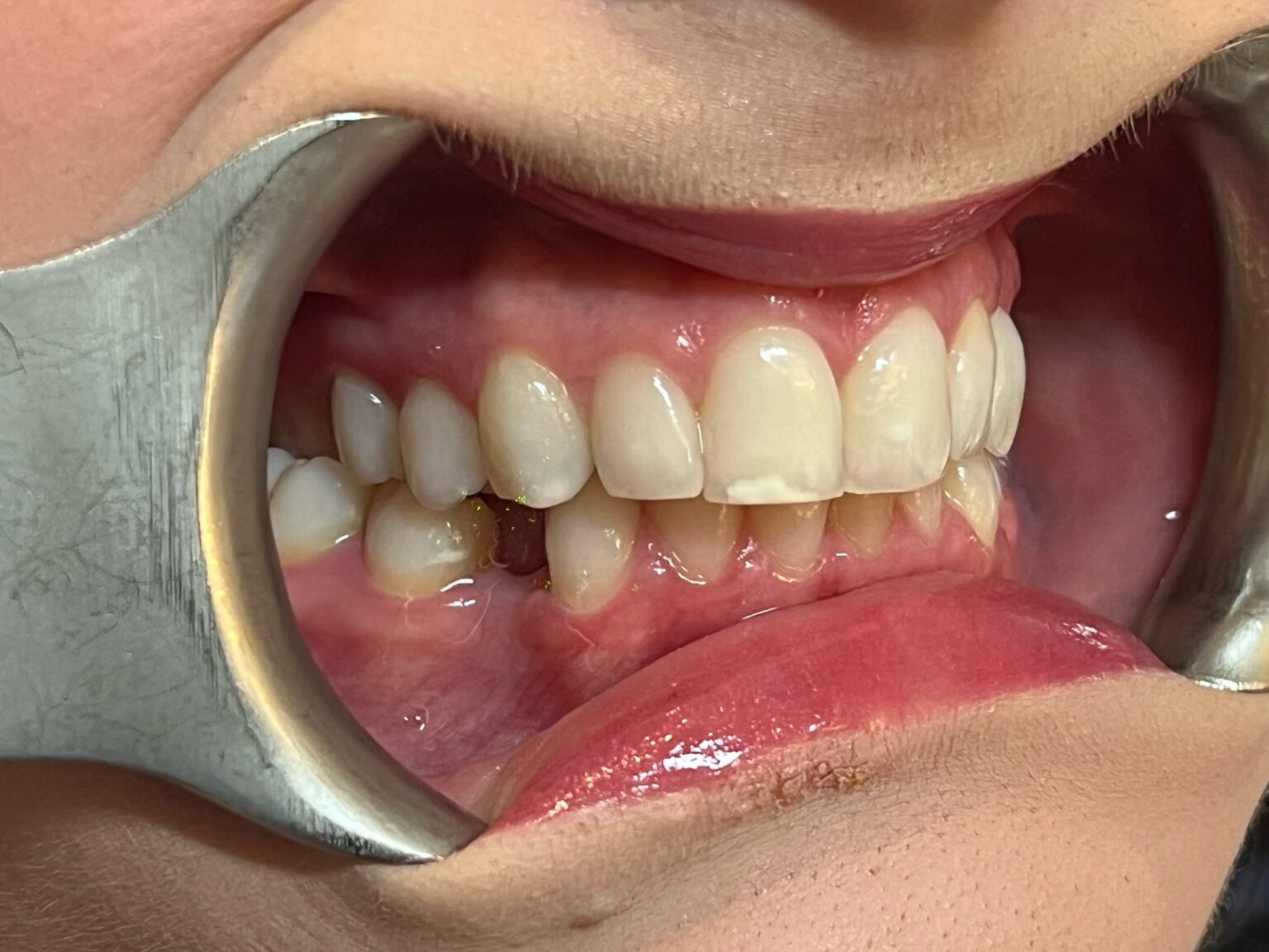 Dental Bridge - Bridgework Dental - Oral Bridge