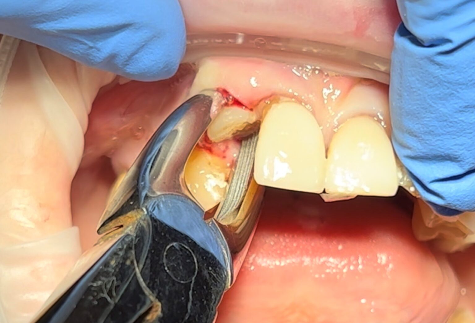Dental Trauma | Dentist Isle of Man