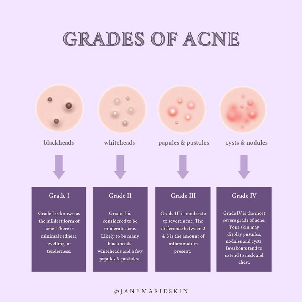 Acne Isle of Man - Isotretinoin - Roaccutane Isle of Man