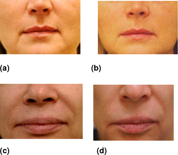 Lasers For Lips Isle of Man - Non Ablative Lasers Isle of Man
