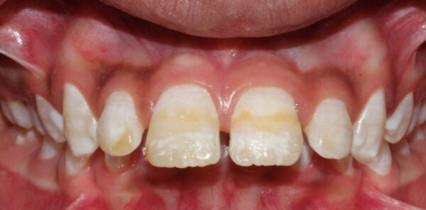 Why Teeth Turn Black - Causes and Prevention - Dentist Isle Of Man