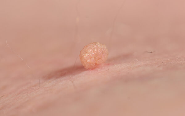 All About Skin Tags: Causes, Treatments & Prevention Tips